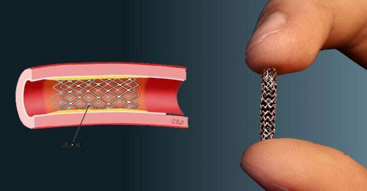 Govt revises coronary stent prices by up to Tk 47,800